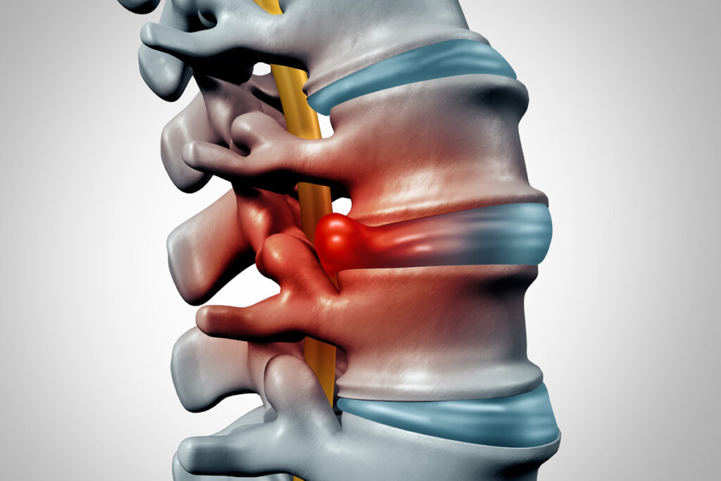 Alternatives to Spinal Fusion | Penn Spine & Orthopedic